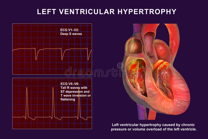 Ecg Changes Stock Illustrations – 39 Ecg Changes Stock Illustrations ...