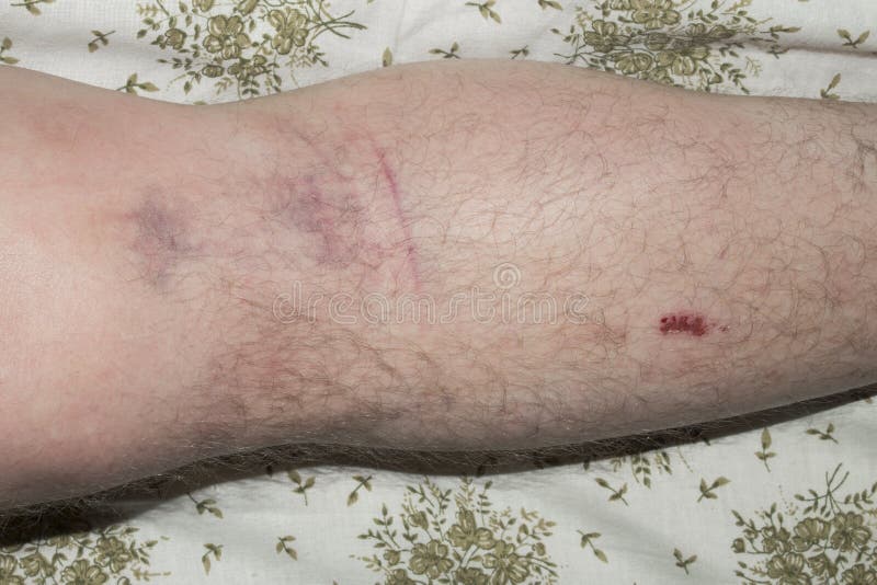 Leg after broken knee stock photo. Image of closeup - 104328512