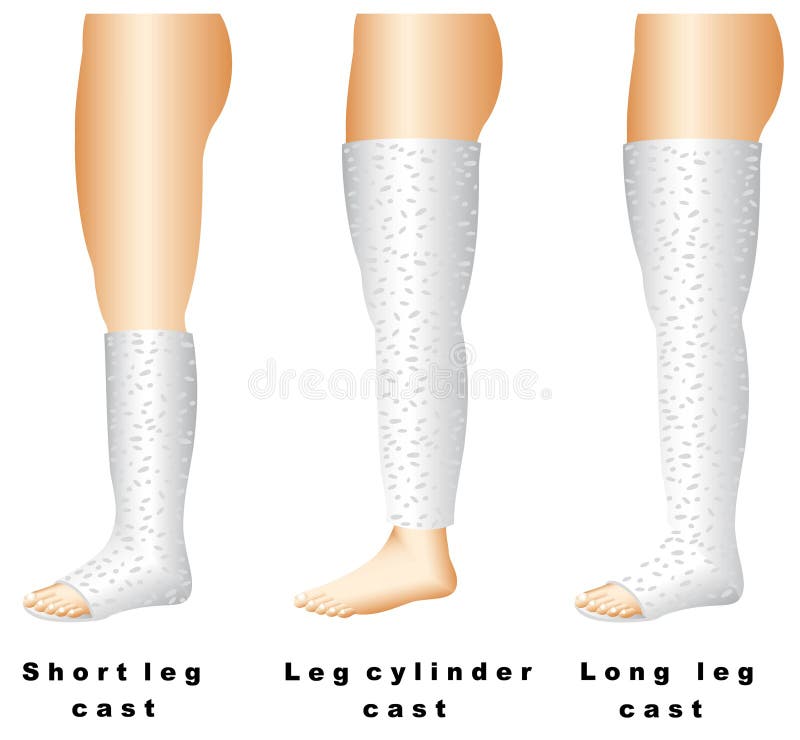 Leg casts stock vector. Illustration of body, hospital - 27400965