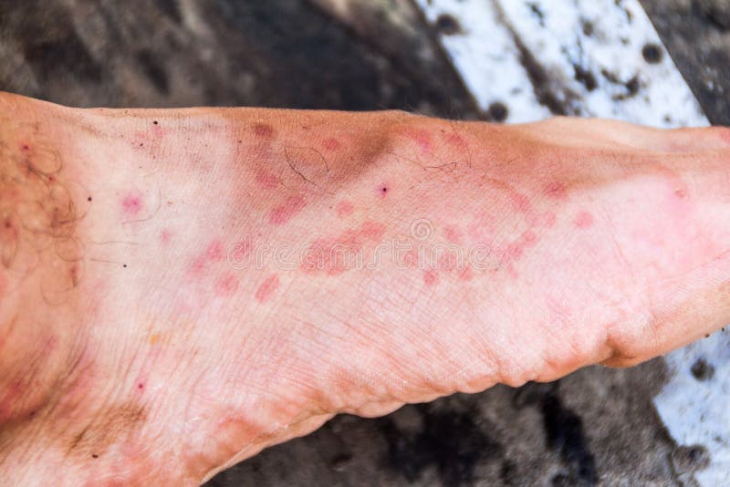 Leg Covered by the Bites of Sandflies Stock Photo - Image of rear, bite ...