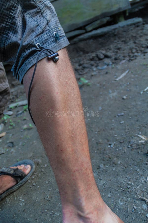 Leg Covered by the Bites of Sandflies Stock Photo - Image of pain, rash ...