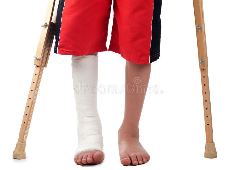 Leg fracture stock image. Image of human, injury, broken - 27563029