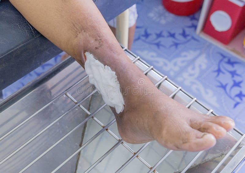 Closeup Infection Wound In The Leg Of Patients Stock Image - Image of ...