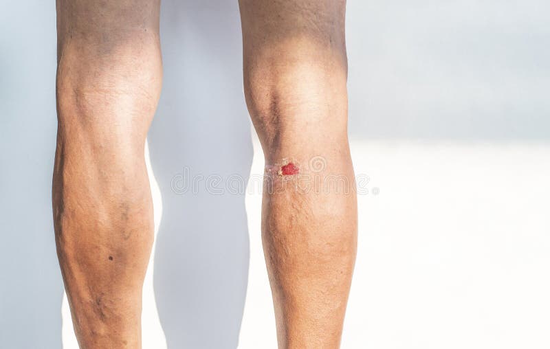 Leg and Knee Muscles of Older People Stock Image - Image of atrophy ...