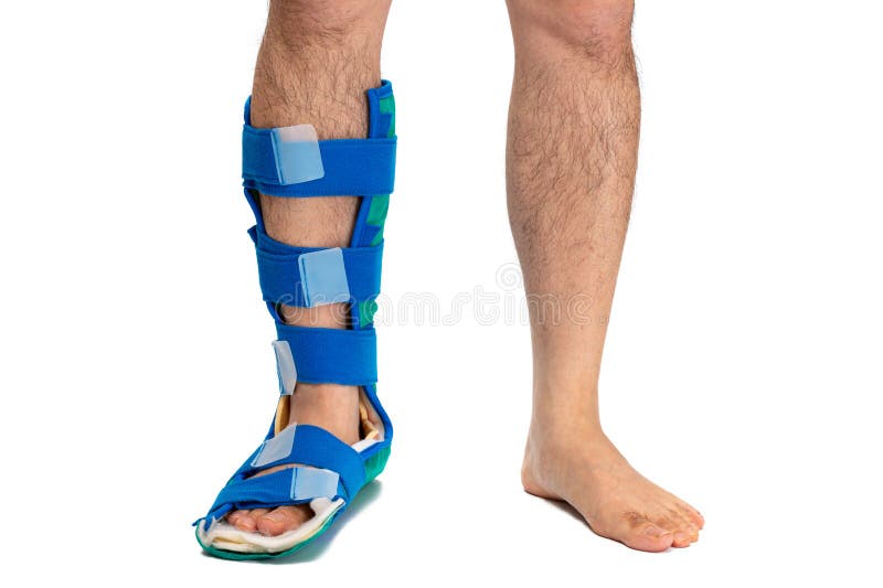 Leg of a Man in a Plaster Cast on a White Background Stock Photo ...