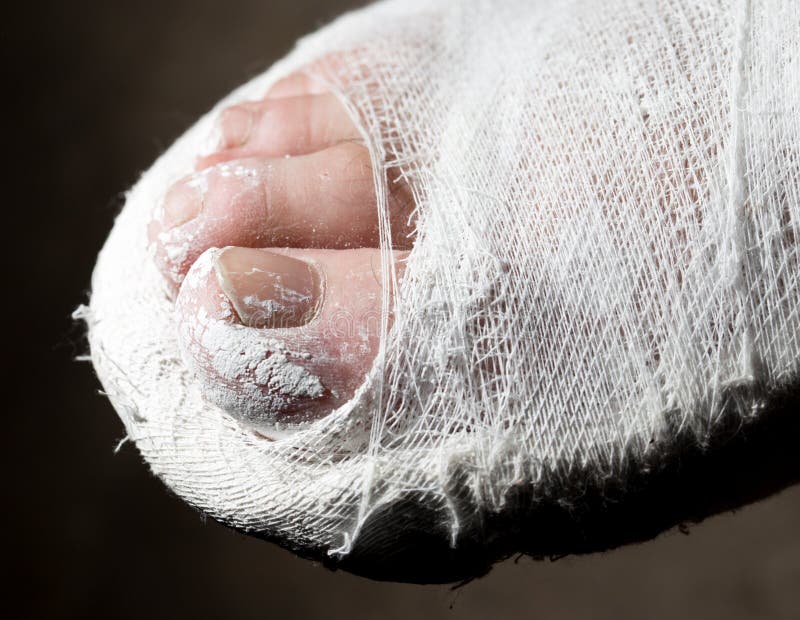 Leg in a Plaster Cast on a Black Background Stock Photo - Image of foot ...
