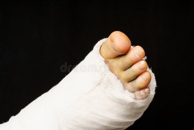 A Leg in a Plaster Cast with a Black Background Stock Image - Image of ...
