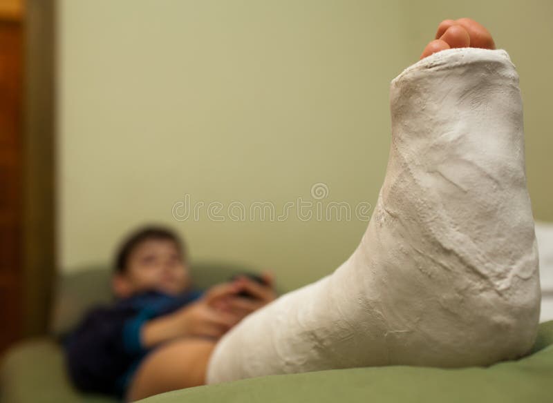 Broken Human Leg In Cast - Child And Boy Stock Image - Image of ...