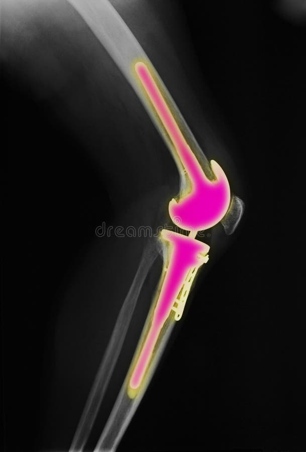 913 Knee Replacement Surgery Stock Photos - Free & Royalty-Free Stock ...