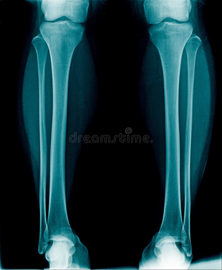 Leg x-ray image stock photo. Image of bone, body, film - 123029978