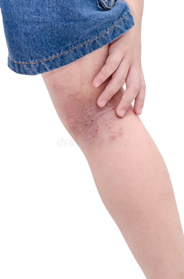 Child Scratching Leg with Red Spot from Insect Bite Stock Image - Image ...