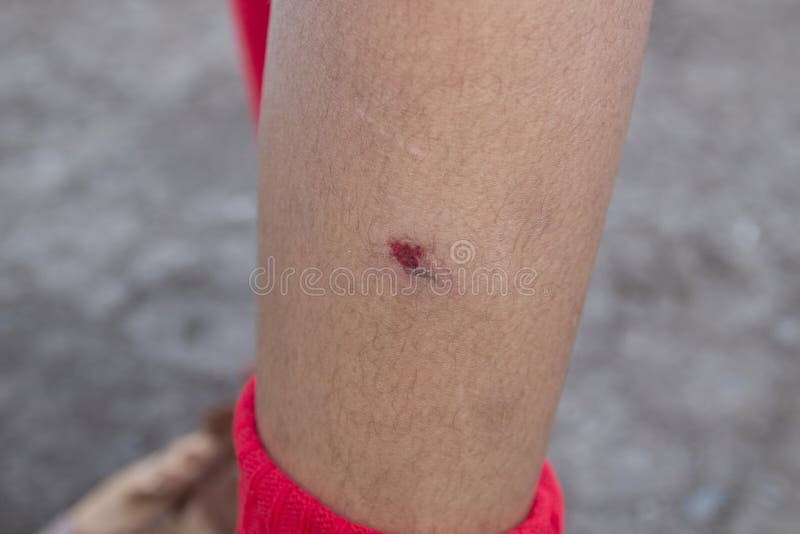 Leg ulcers stock photo. Image of closeup, hospital, medicine - 80750224