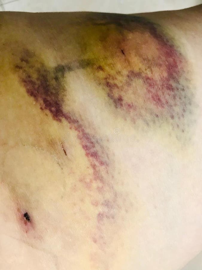 This is a Leg after Varicose Vein Surgery Stock Photo - Image of ...