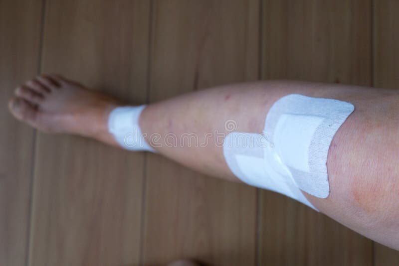 Leg Wit Bruises after Operation Stock Photo - Image of break, joint ...