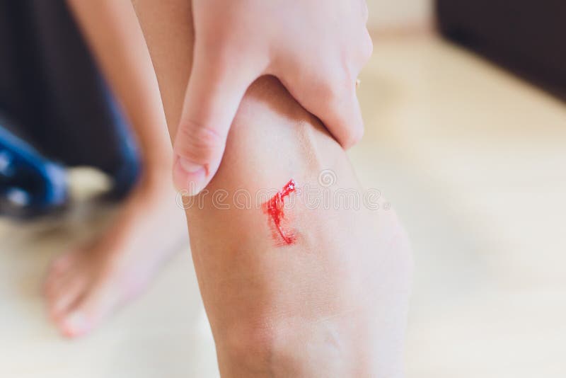 Bleeding Skin Wound Stock Photos - Download 884 Royalty Free Photos