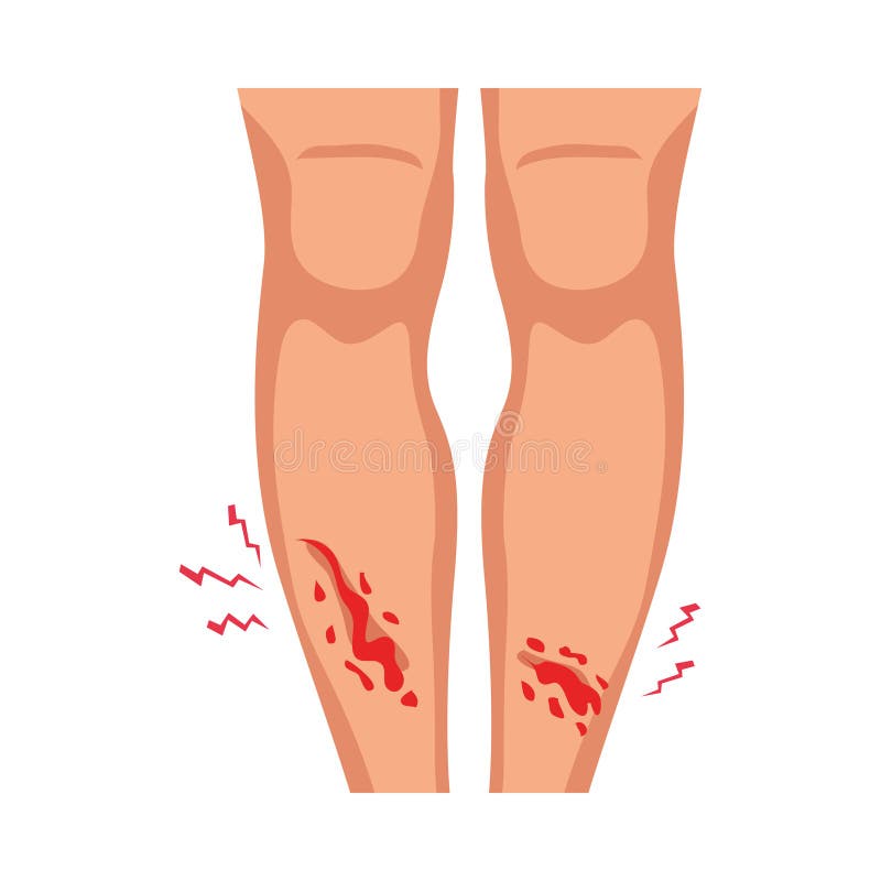Legs Wounds Illustration stock vector. Illustration of lifestyle ...