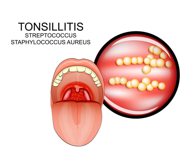 Les Maladies D'inflammation De La Gorge Illustration de Vecteur ...