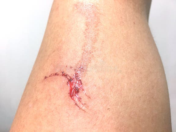 Lesion by Accident Situation Live Stock Photo - Image of skin, closeup ...