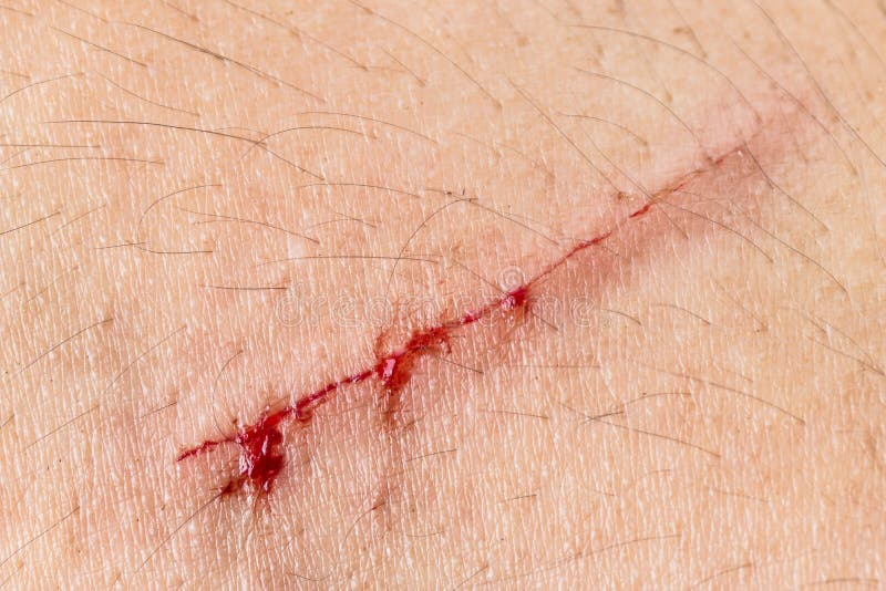 Lesion on arm stock photo. Image of pain, medical, person - 113198920