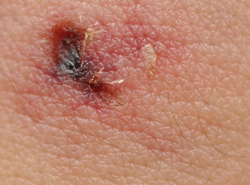 Lesion On Arm Skin Begin Scab Dried On The Epidermis. Stock Photo ...