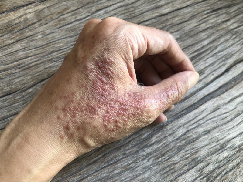 Scratch Blister Skin Foot Heel Stock Photos - Free & Royalty-Free Stock ...