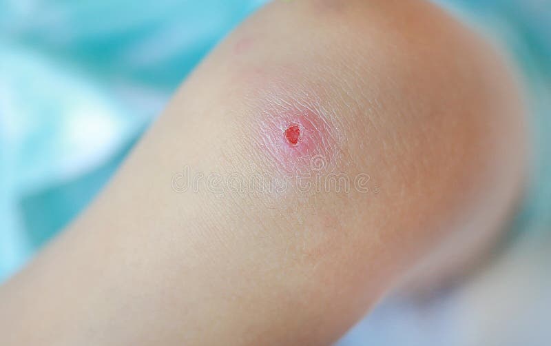 Lesions of the knee. stock photo. Image of child, gash - 113844008