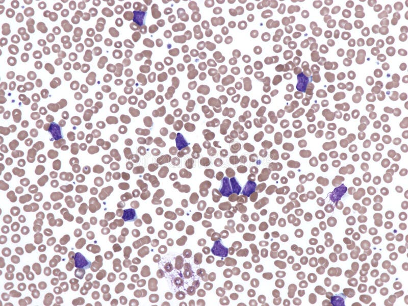Leucemia linfoide aguda. . foto de stock. Imagem de oncologia - 350453466