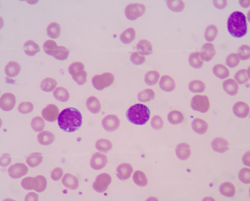 Leucemia Mieloide Acuta (AML) Immagine Stock - Immagine di ...