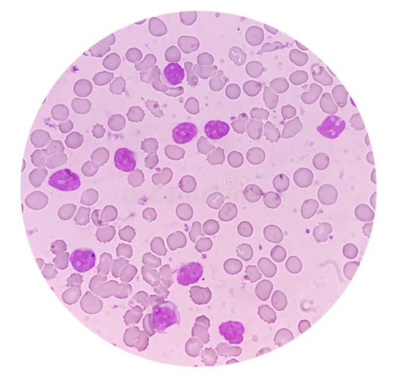 Leukemia. Blood Cells, Blast Cells and Immature Leukocytic Cells in ...