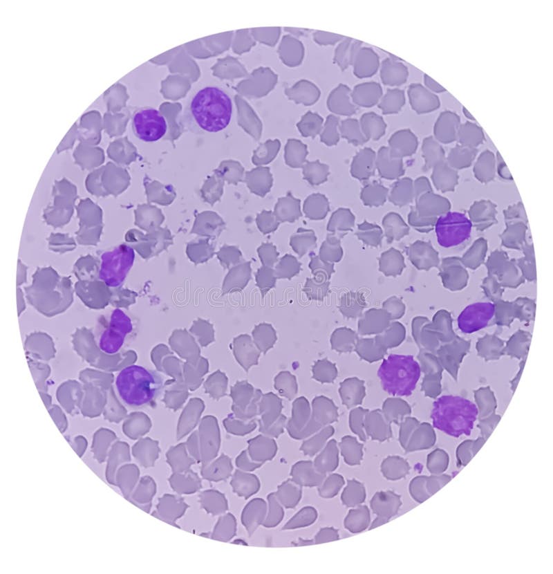 Leukemia. Blood Cells, Blast Cells and Immature Leukocytic Cells in ...