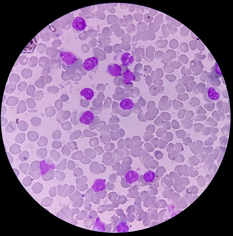 Leukemia. Blood Cells, Blast Cells and Immature Leukocytic Cells in ...