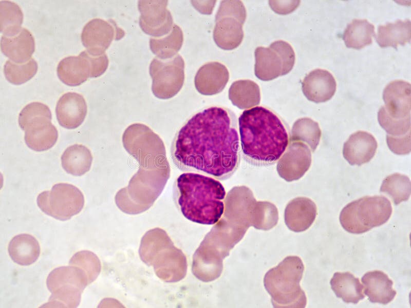 Leukemia cells stock image. Image of disease, anemia - 100345023