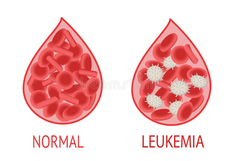Leukemia. Comparison of a Drop of Blood with Normal and Leukemic Blood ...