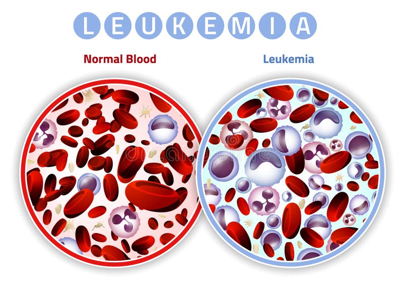 Leukemia Stock Illustrations – 6,005 Leukemia Stock Illustrations ...