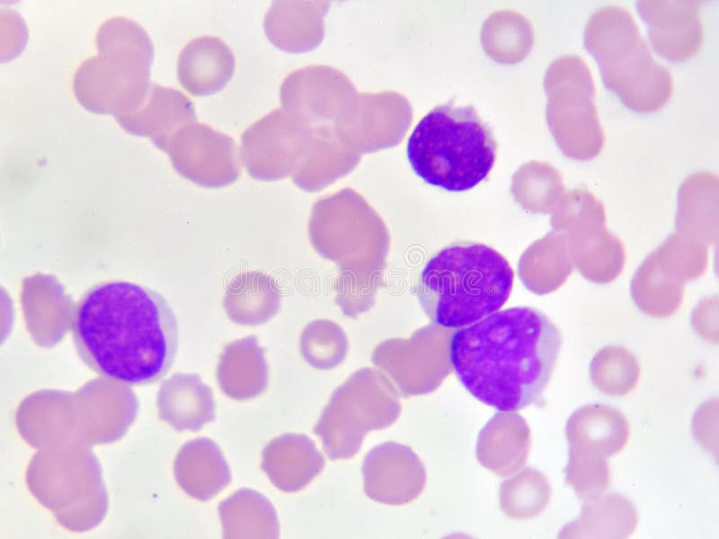 Akut myeloid leukemi AML arkivfoto. Bild av kontroll - 99238624