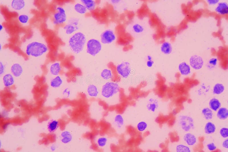 Leukemie Stockfoto's - Download 2,676 Royalty Free Photos