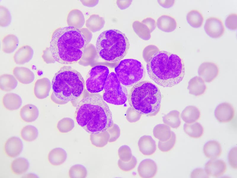 Leukemiecel stock afbeelding. Image of abnormaal, leukocyt - 92253749