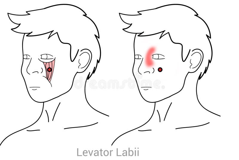 Levator Labii Myofascial Trigger Point Nose Pain Stock Illustration ...