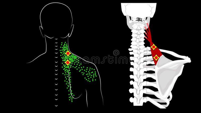 Levator Scapulae Muscle. Trigger Points and Muscle Structure. Pain in ...
