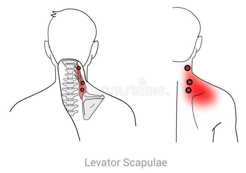Levator Scapulae Myofascial Trigger Point Rear Upper Neck Pain Stock ...