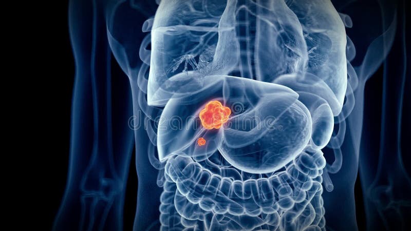 Leverkanker stock footage. Video of animatie, biologie - 69608702