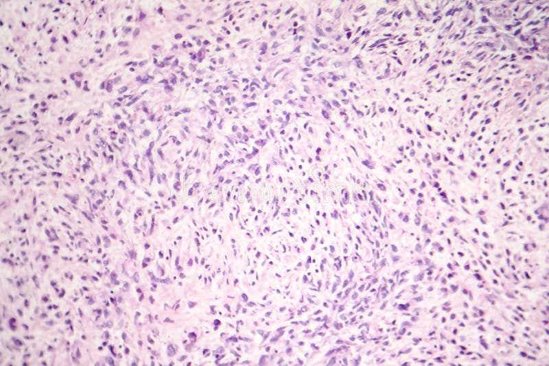 Malignant Cells, Photo Under Microscope Stock Photo - Image of ...