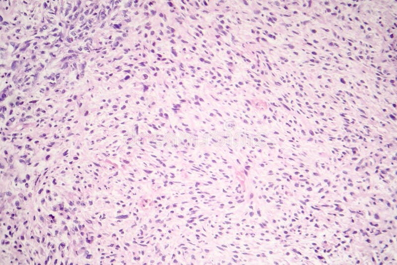 Malignant Cells in Pleural Fluid. Stock Image - Image of medical ...