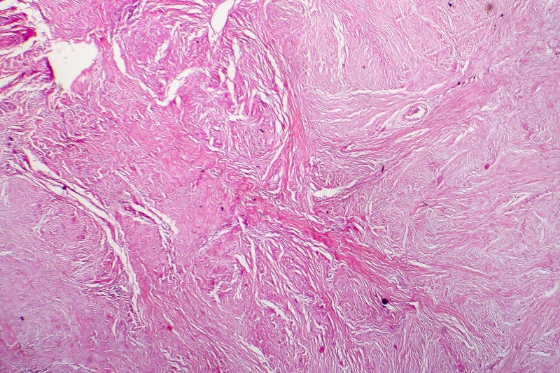 Light Micrograph of Scar Tissue Stock Photo - Image of scar ...