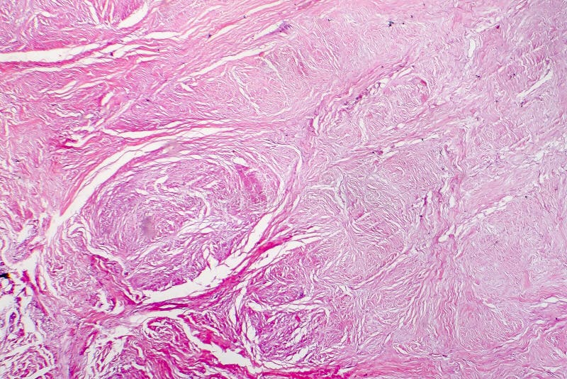 Light Micrograph of Scar Tissue Stock Image - Image of scar ...