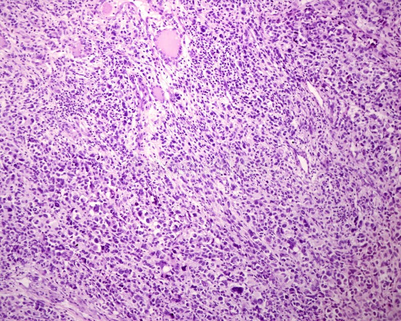 Human Skin Pleomorphic Sarcoma Stock Photos - Free & Royalty-Free Stock ...