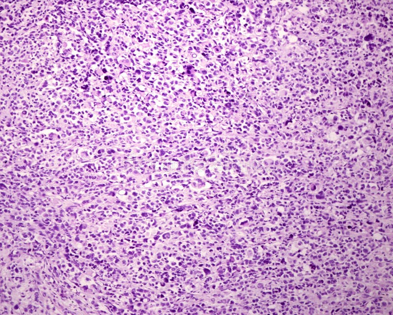 Human Skin. Pleomorphic Sarcoma Stock Image - Image of disease ...