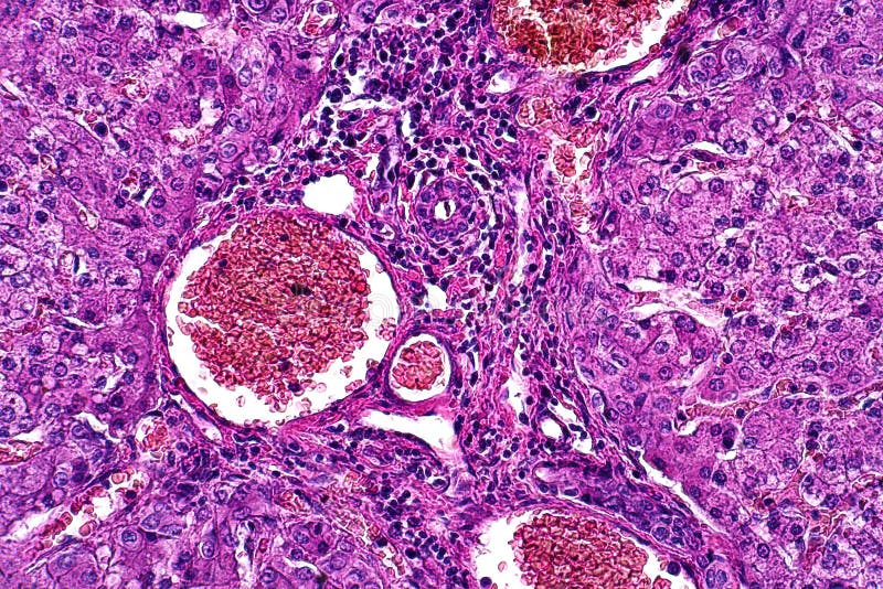 Light Microscope of Parenchymatous and Fatty Degeneration of Liver ...