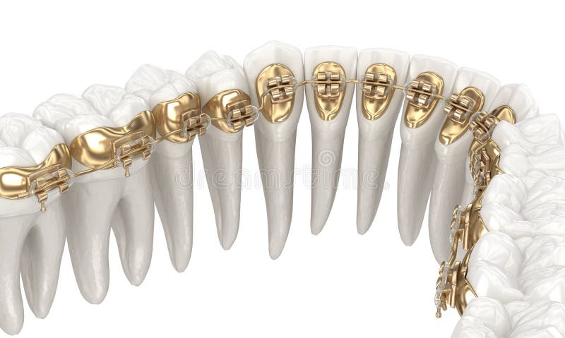 Lingual Braces System. 3D Illustration Concept of Golden Braces Stock ...