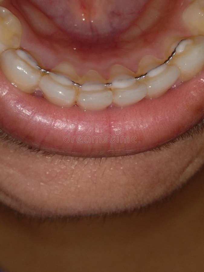 Lingual Retainers after Orthodontic Treatment Stock Photo - Image of ...